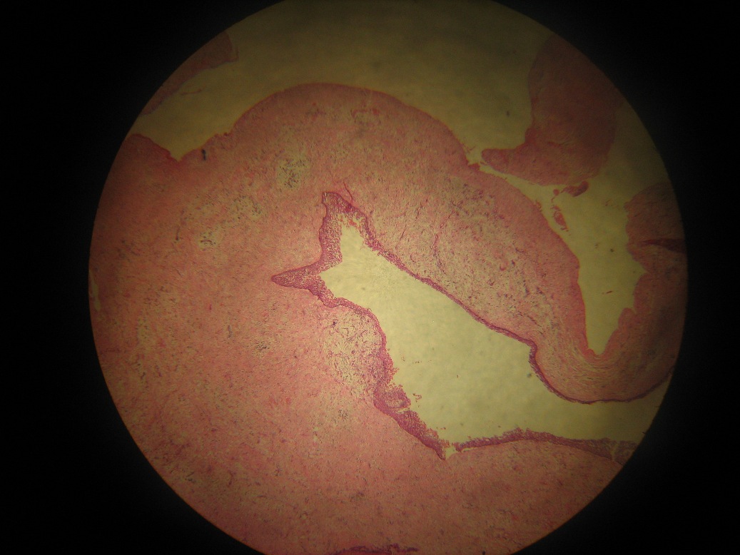 Dentistry and Medicine: Cysts in the mouth and jaws with histologic Slides
