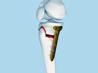 ORTHO ONE ORTHOPEDIC: High tibial osteotomy surgery in bangalore ...