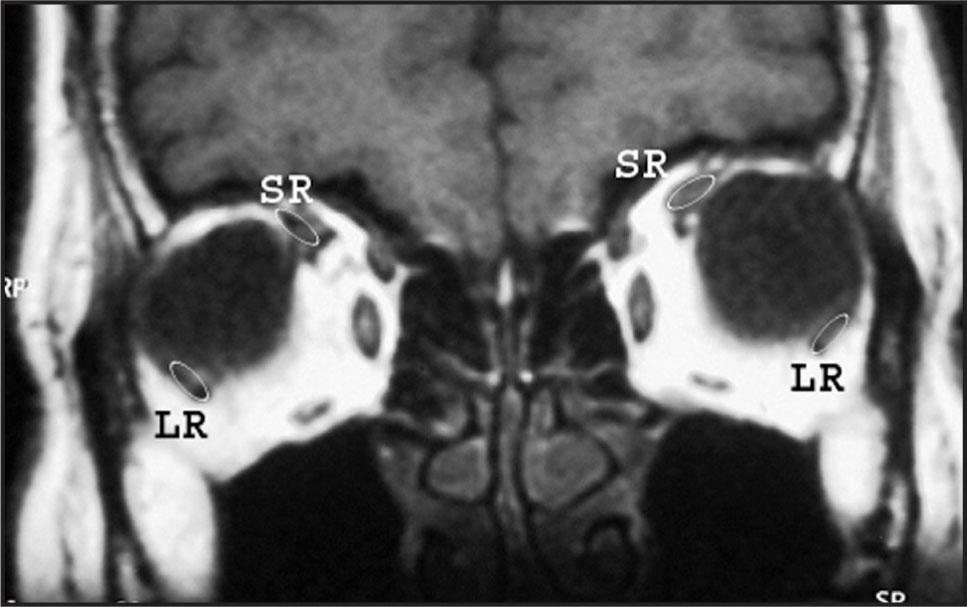 Eyelid Surgery by Prof Dr CN CHUA 蔡鐘能: Doc, Can You Straighten My Eyes? V