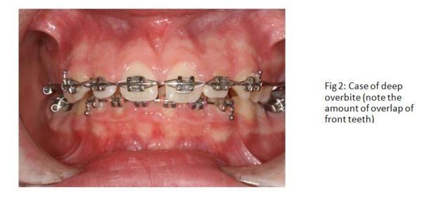 Dental Library: Bite Plates