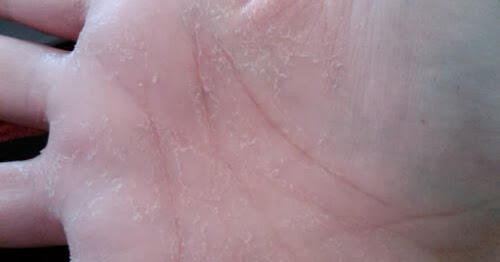 Top 12 Tips For Peeling Skin on Hands, Palms and Fingertips | Best ...