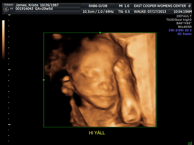 Here Comes Baby James 20 Week Anatomy Scan Here Comes Baby James 20 Week Anatomy Scan