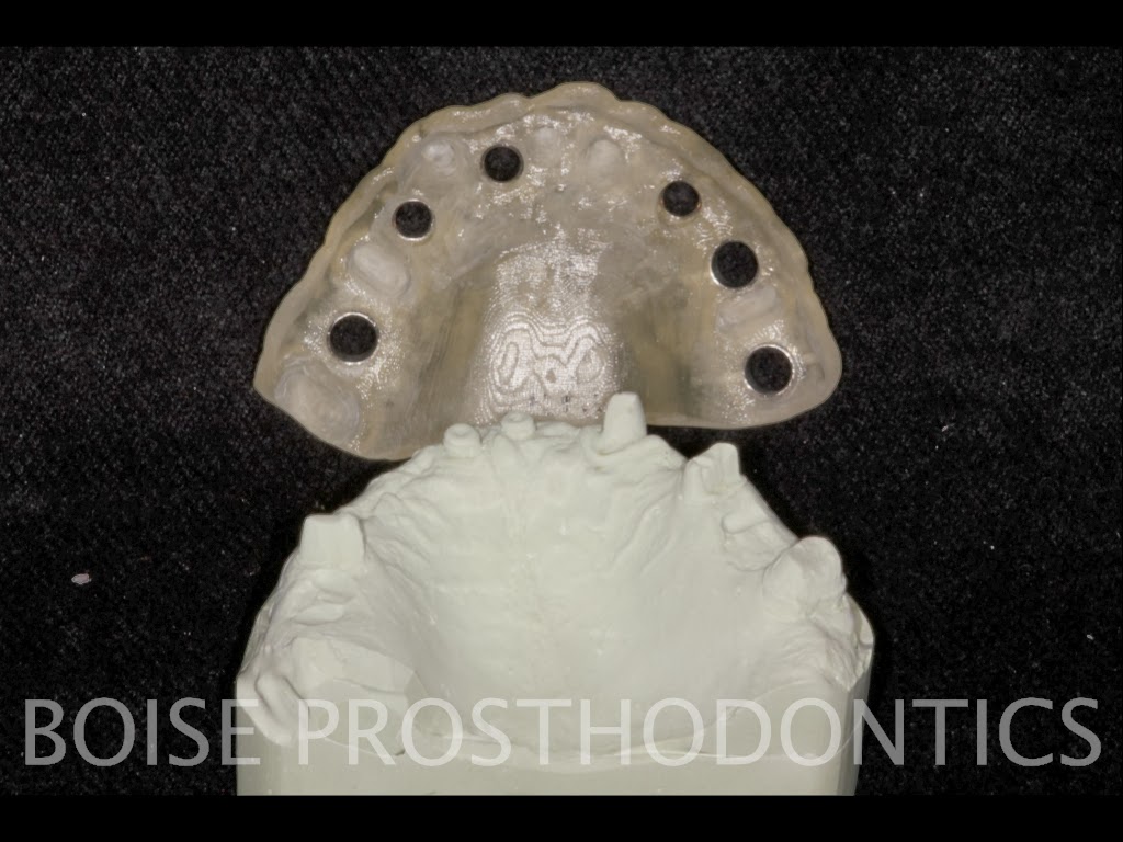 Boise Idaho Prosthodontics: Maxillary Implant Rehab Provisional, Index ...