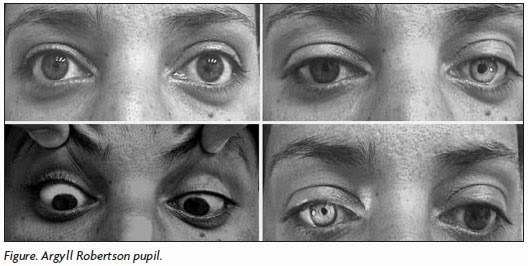 Pupil Argyll Robertson Medical Articles
