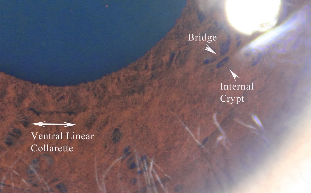 Modern & Multidimensional Iridology: Signs at Internal Collarette ...