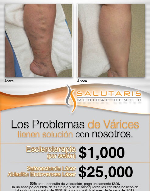 Cirugia Plastica Estetica en Guadalajara Mexico: Tratamiento de Varices ...