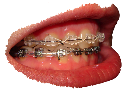 Mein Leben mit Zahnspange: Verblockung? Gummikette? Hä?