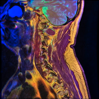 Nevit's blog: Color MRI of the Cervical verterbrae