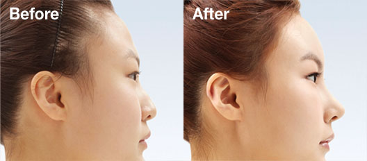 ID Hospital Korea: korea double eyelid surgery + rhinoplasty, Double-up ...