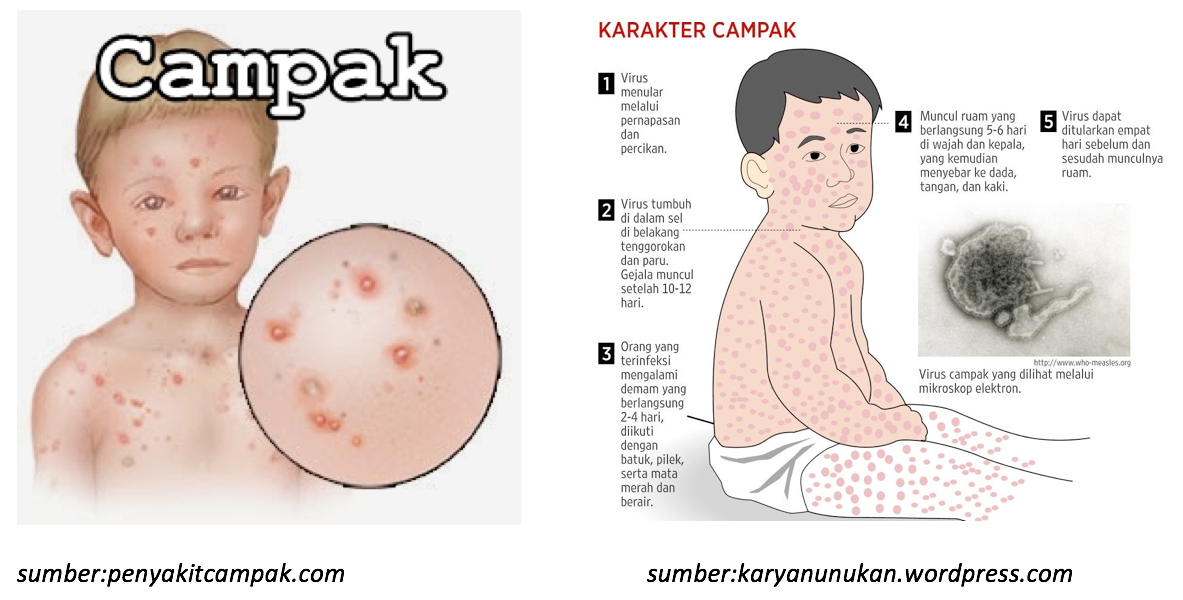 Risalah Husna: Lindungi Anak Dari Kelainan Bawaan Dengan Imunisasi ...