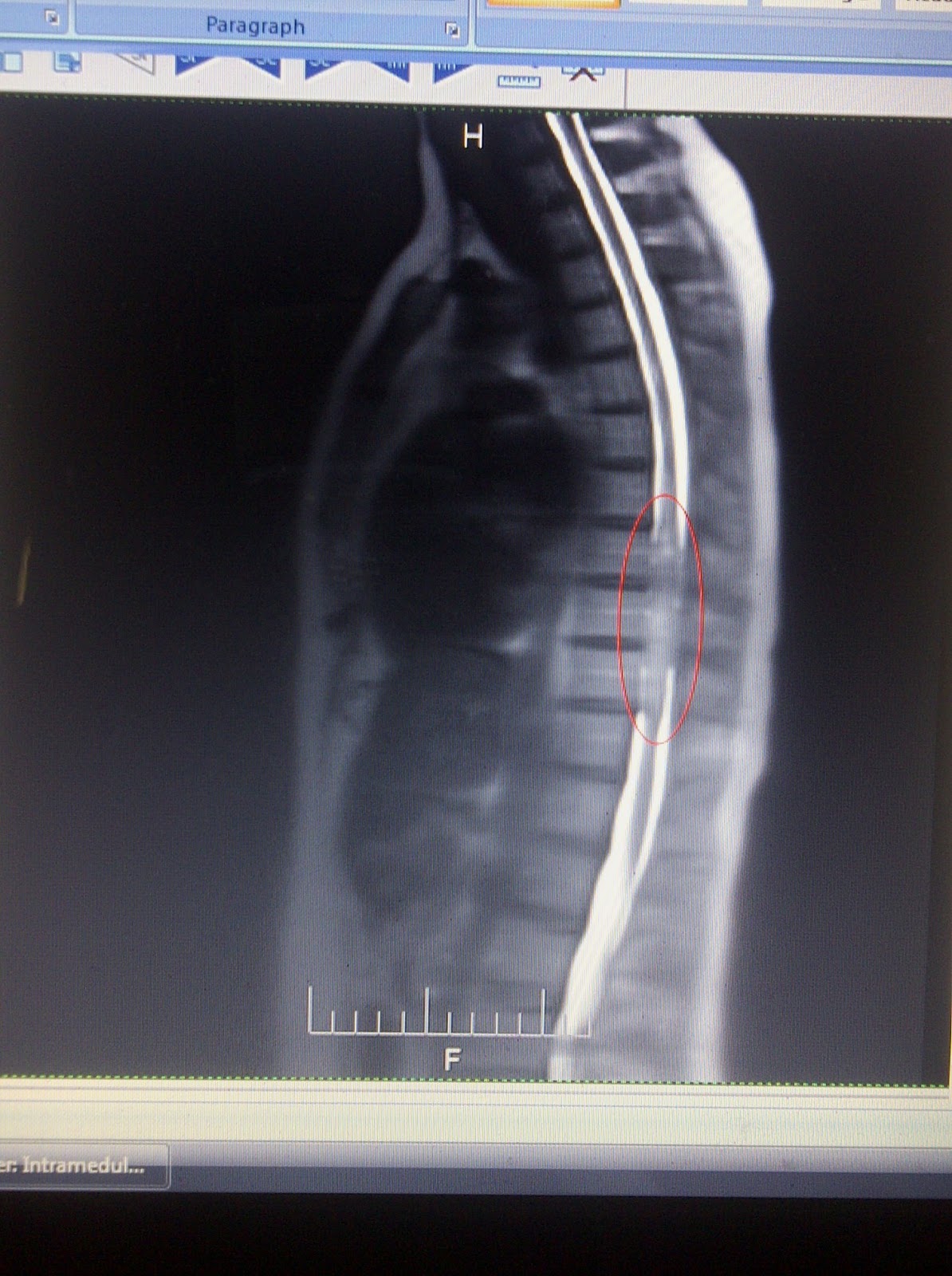 Intramedullary Ependymoma - my journey: Introducing Herm the Worm