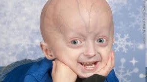 Adeal News: Progeria Facts as rare Genetic Condition | Lite Review