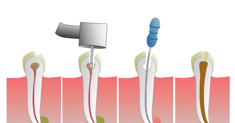 Perawatan Saluran Akar: Perawatan Saluran Akar