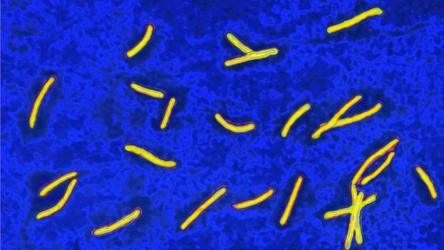 UNIT TIBI / KUSTA JKNPAHANG: TUBERCULOSIS