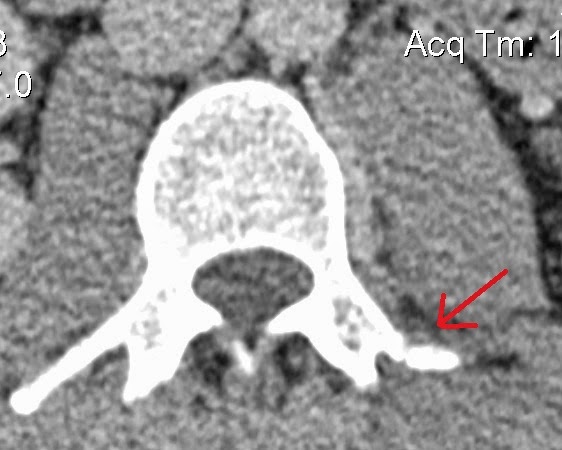 My herniated and degenerated lumbar disc journey.: Visit to Orthopedic ...