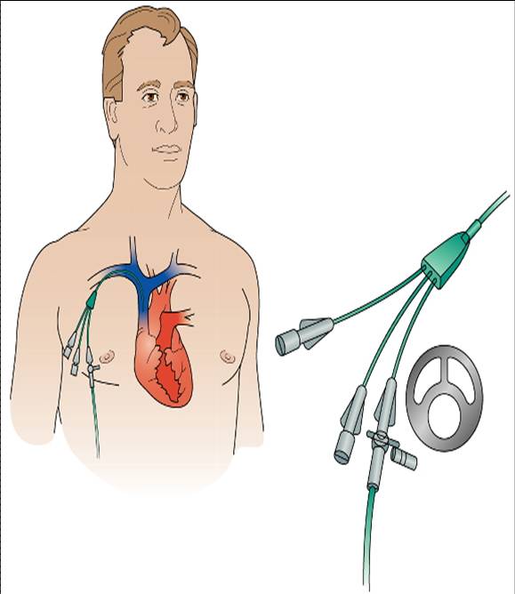 Central Venous Catheter (CVC).ppt | Free Medical Slids