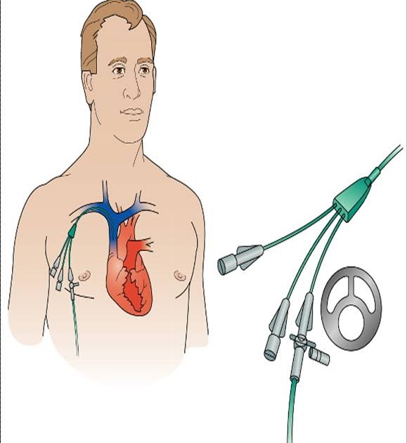Central Venous Catheter (CVC).ppt | Free Medical Slids