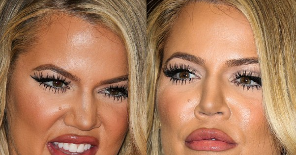 Khloe Kardashian finally admits facial fillers wrecked her face