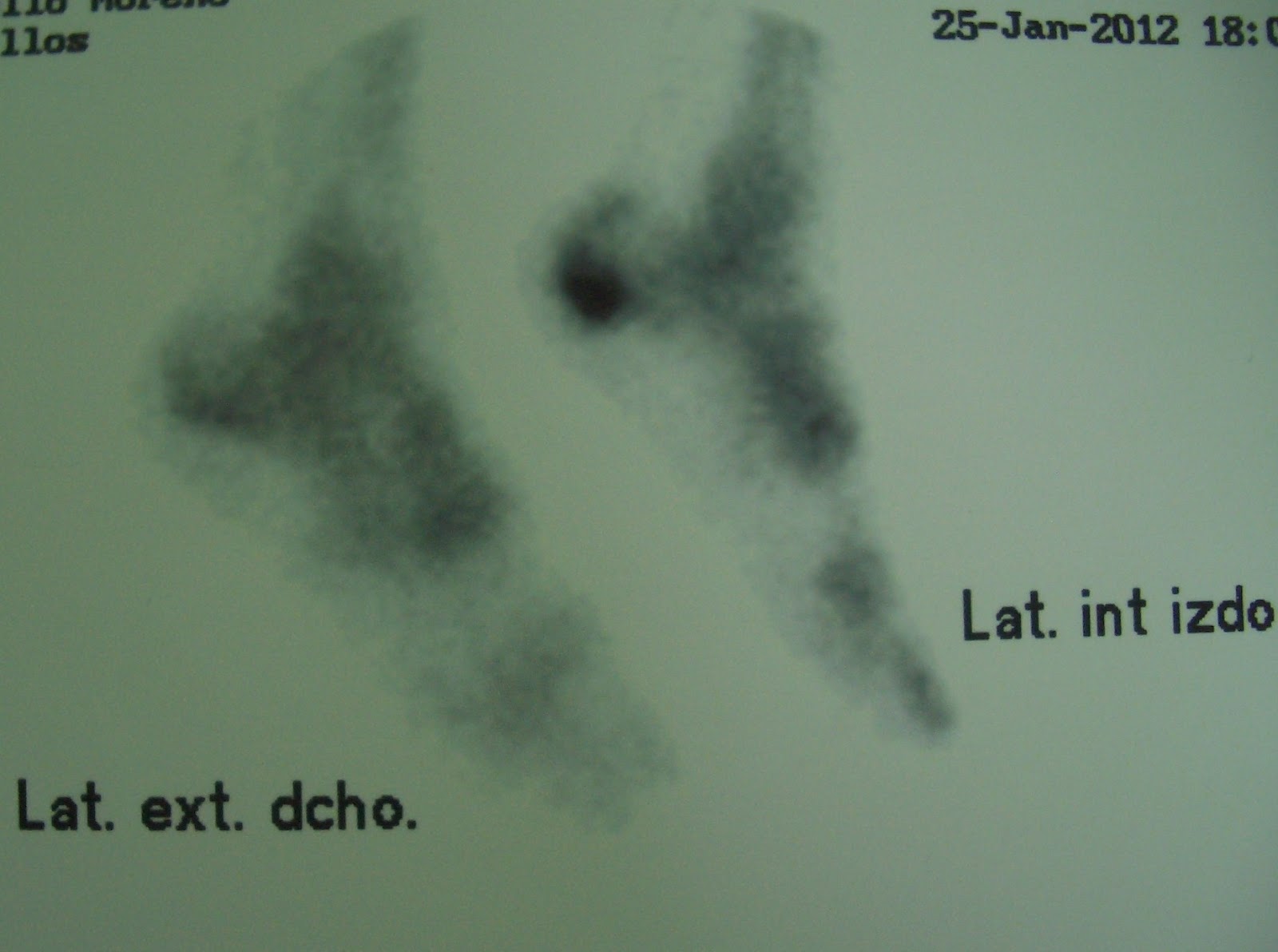 Podo Basas al Día: Fascitis plantar. Micosis intertriginosa. Papiloma ...