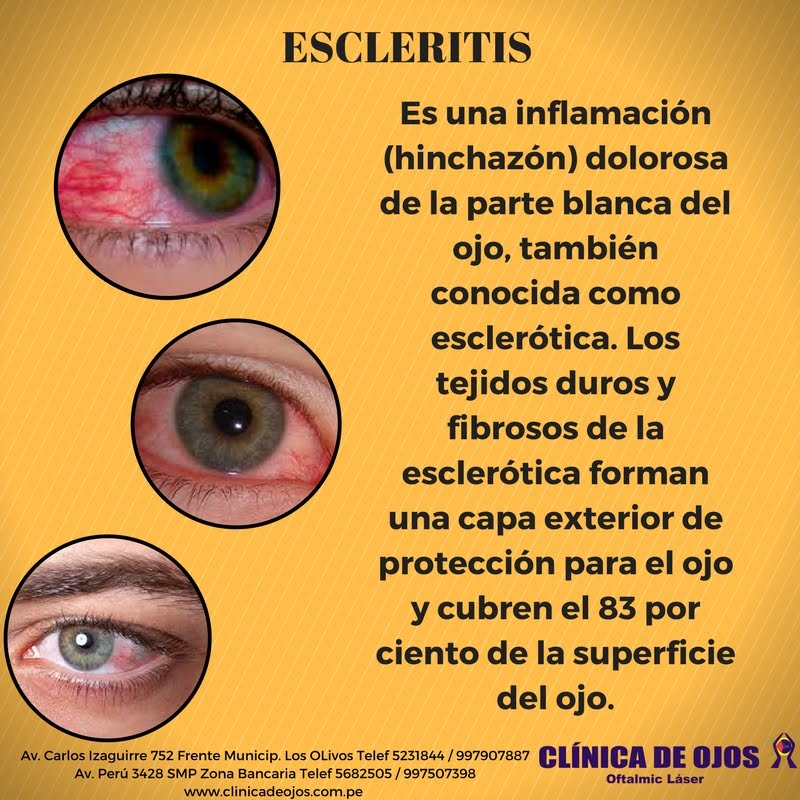 Clínica de Ojos Oftalmic Láser: ESCLERITIS