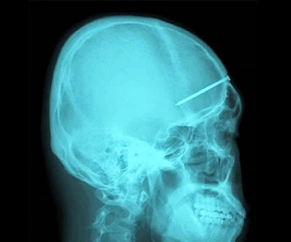 AMAZING FACTS OF LIFE: Crazy Things Found Inside of People