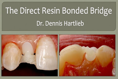 RIBBOND: How to create a Direct Resin Bonded Bridge