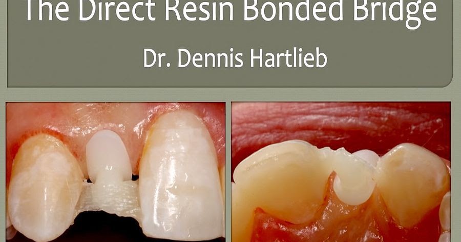 RIBBOND: How to create a Direct Resin Bonded Bridge - Odonto-Tv