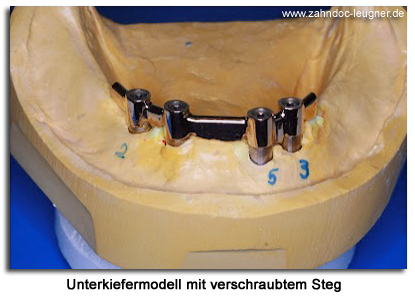 Zahnarzt Bochum Herne: Implantate, Implantation Bochum informiert: Die ...