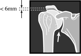 UW Shoulder and Elbow Academy: Rotator Cuff 7 - X-ray, ultrasound and ...