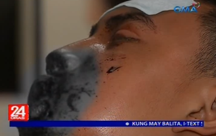Vapes or E-Cigarette explode at man's mouth - Where In Bacolod