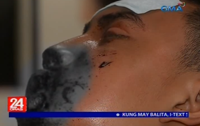 Vapes or E-Cigarette explode at man's mouth - Where In Bacolod