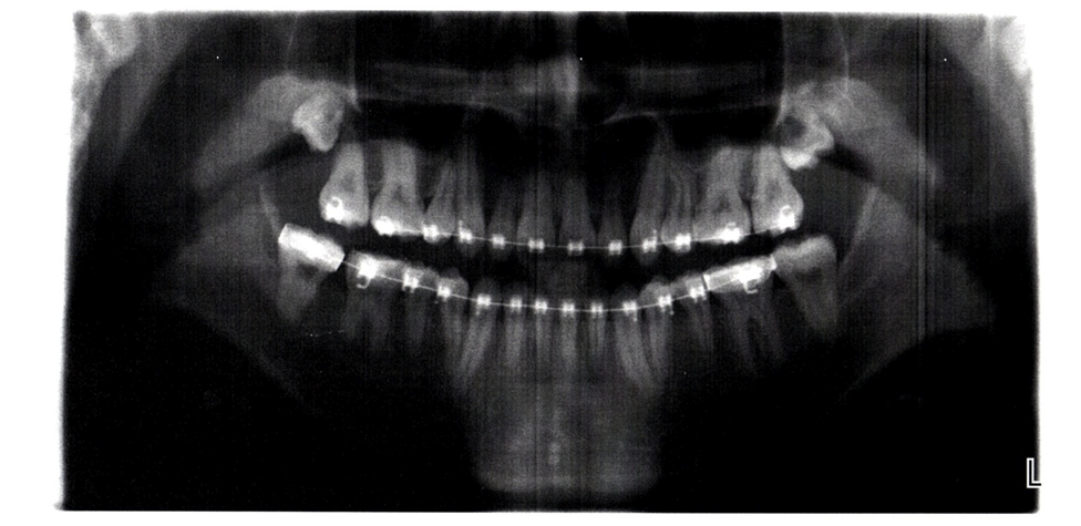 OrthoWorks: Saving Impacted Molars