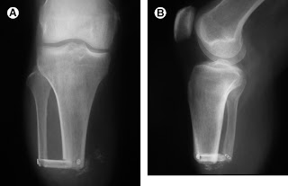 Snowboarder vs. Tree: The Guy That's Going to Cut My Leg Off