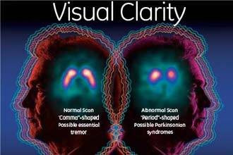 Parkinson's - My Journey(al) through this: The DaTscan or how to get ...
