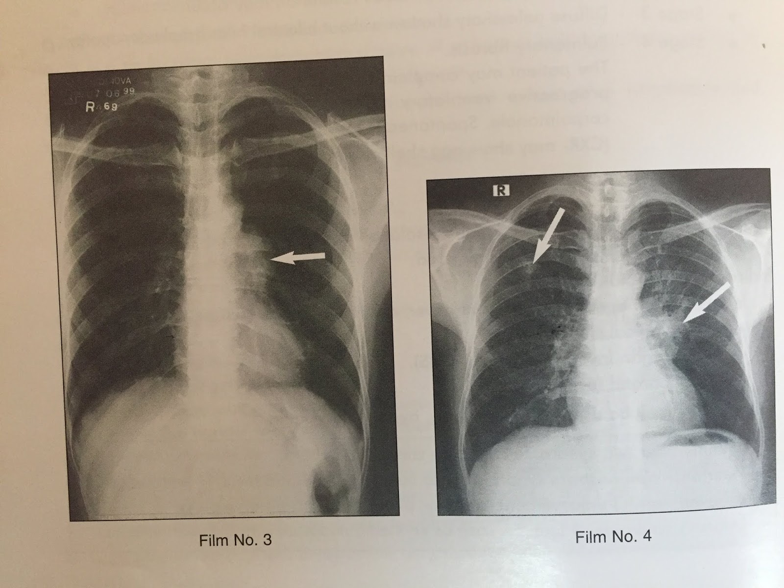 XRAYS OF UNILATERAL HILAR LYMPHADENOPATHY