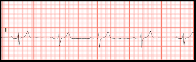 Heart Block Quiz 299