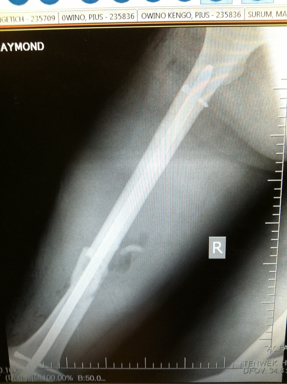 Venture Forth: The SIGN Nail