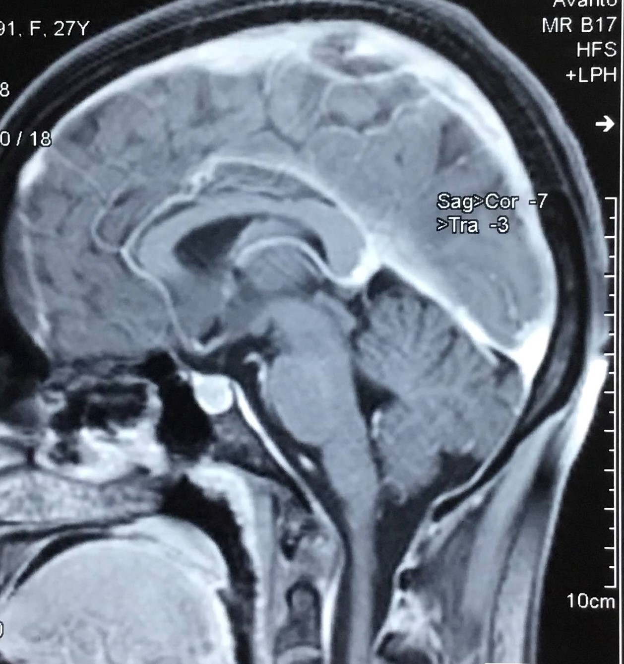 Intracranial Hypotension : MRI - Sumer's Radiology Blog