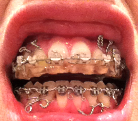 Brace Yourself: Day 65: Surgery Timeline In Teeth Pictures