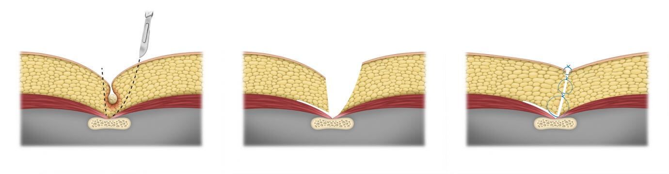 Pilonidal cyst on the butt: Plastic closure according to Karydakis