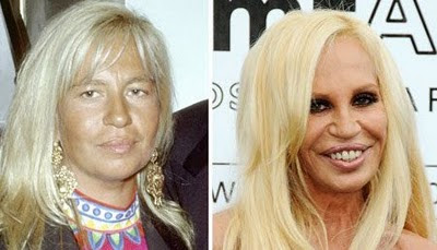 Versace plastic surgery