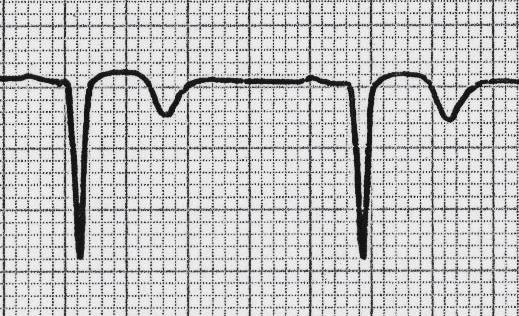Infark Miokardium Akut dan Evolusinya | INA - ECG