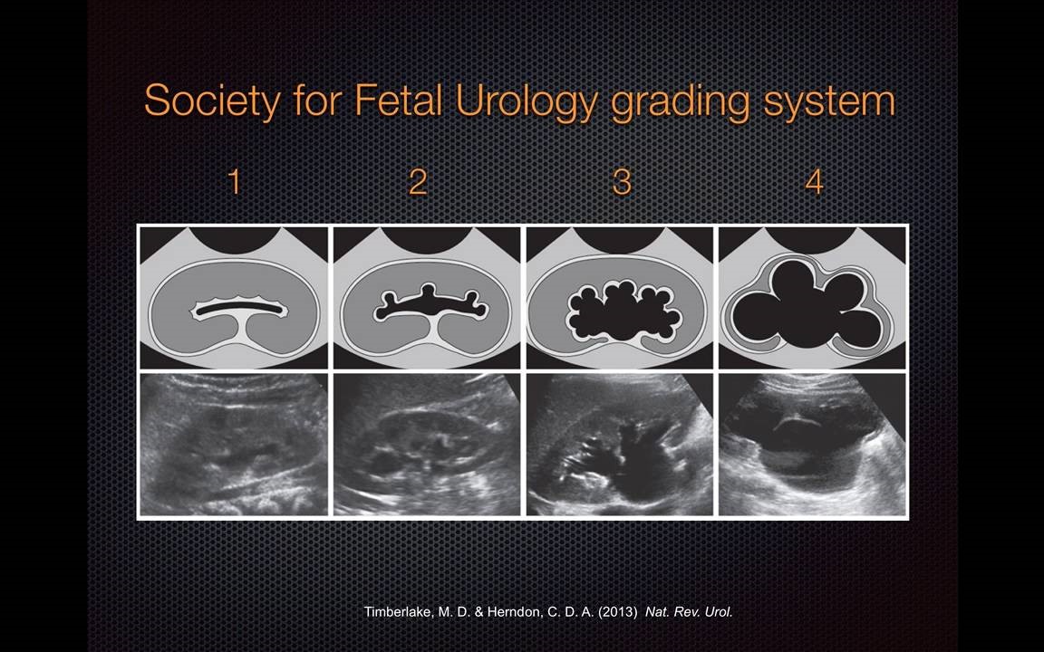 Urogenital Tract Abnormalities - SONOVISION ULTRASOUND