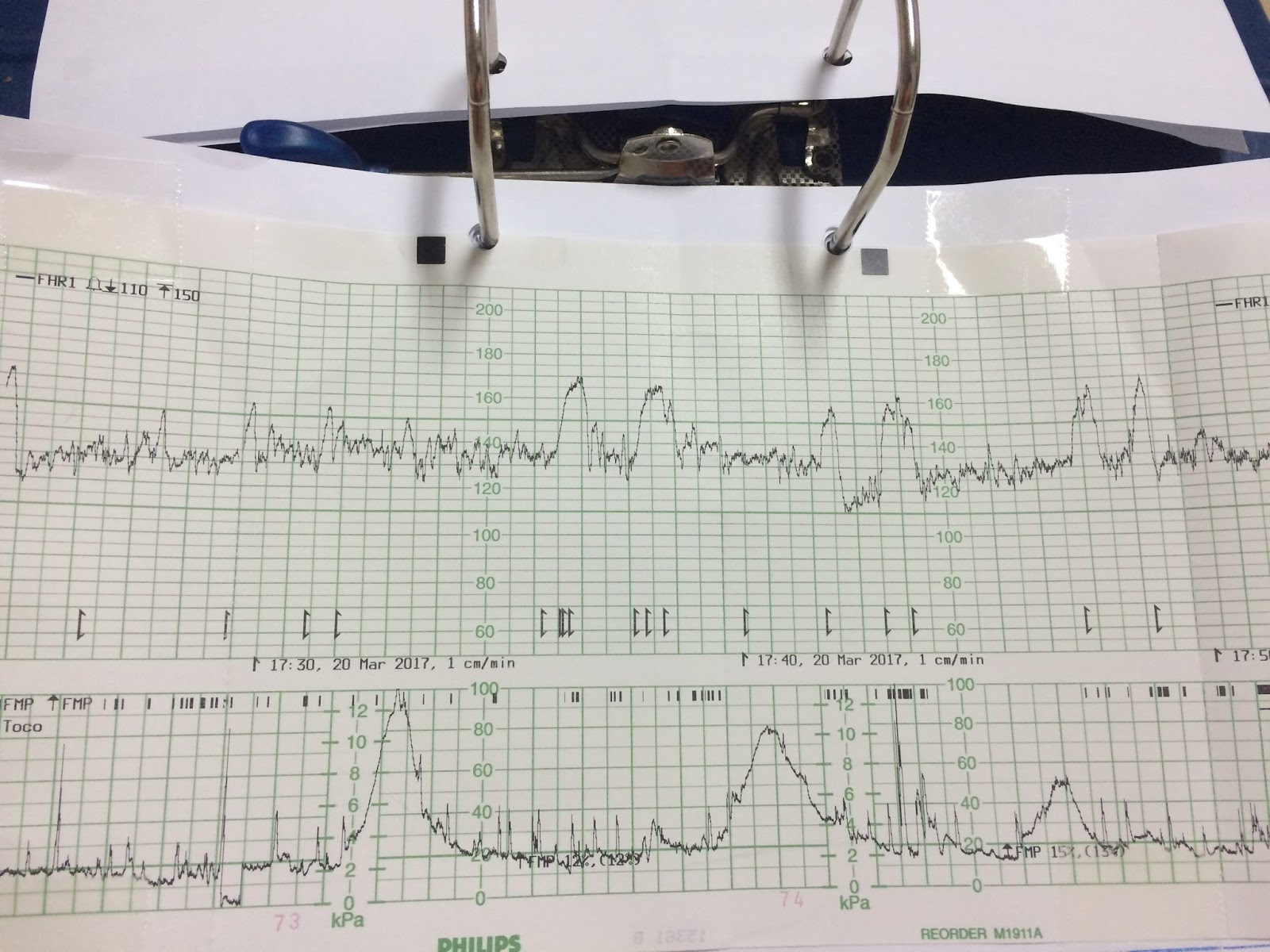 CTG ( CardioTocoGrafi) ~ info up date bidan