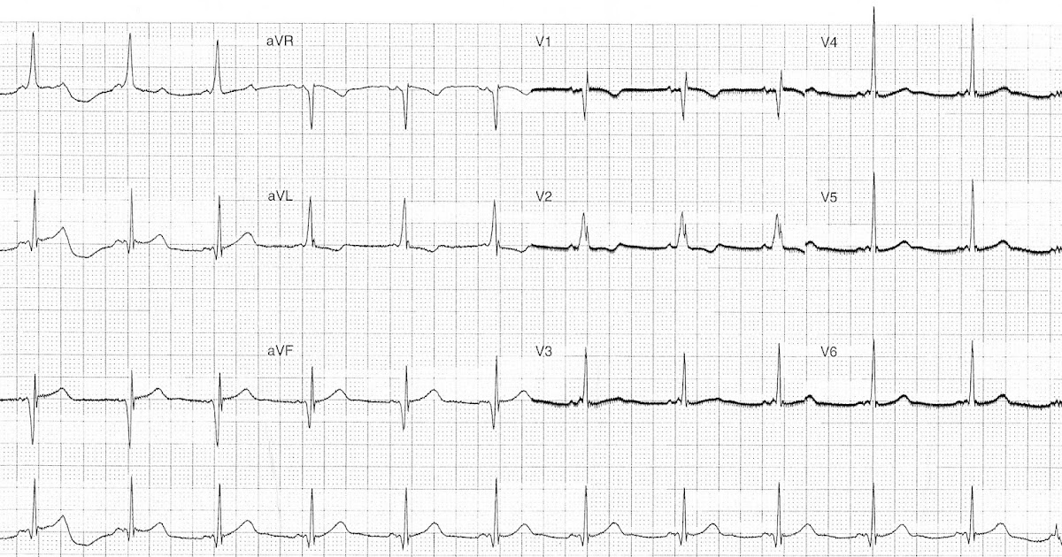 ECG of the Week: ECG of the Week - 18th July 2016 - Interpretation