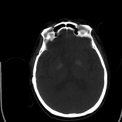 Post Gad: Idiopathic BG and Cerebellar Calcification.