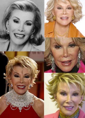 Joan Rivers Plastic Surgery Before and After Botox and Cheek ...