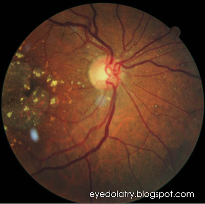 Retinal Photography: Macula - Eyedolatry