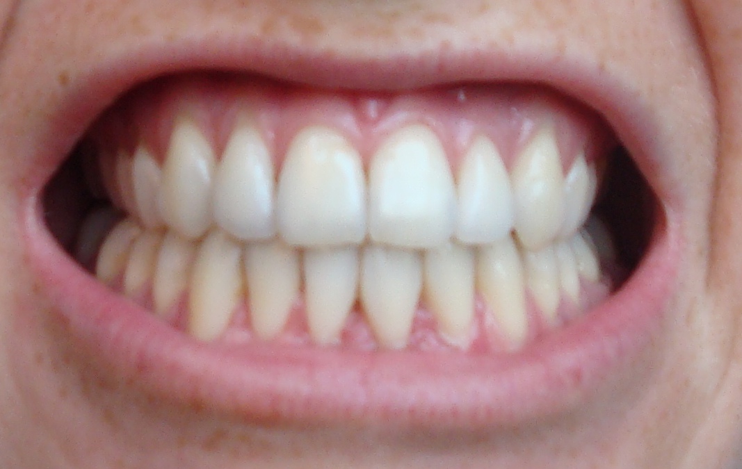 Sannes kaakoperatie: Tandvlees: deel III: eindelijk af!