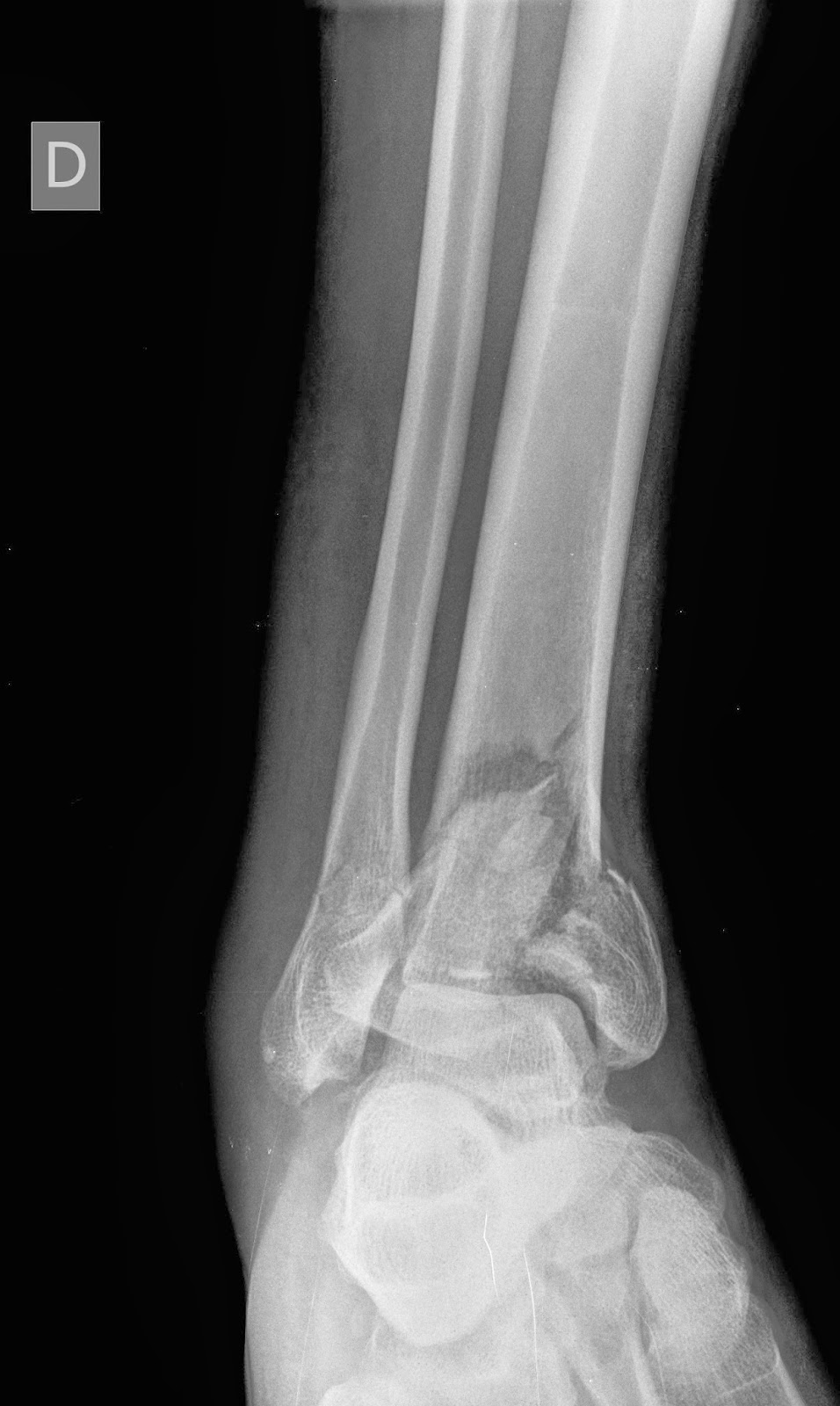 Fractura Pilao tibial e maleolo lateral dto + Fractura maleolo medial ...